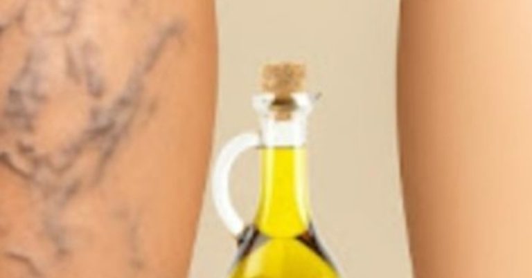 Grandmas Natural Remedy for Varicose Veins Aloe Vera Apple Cider ...